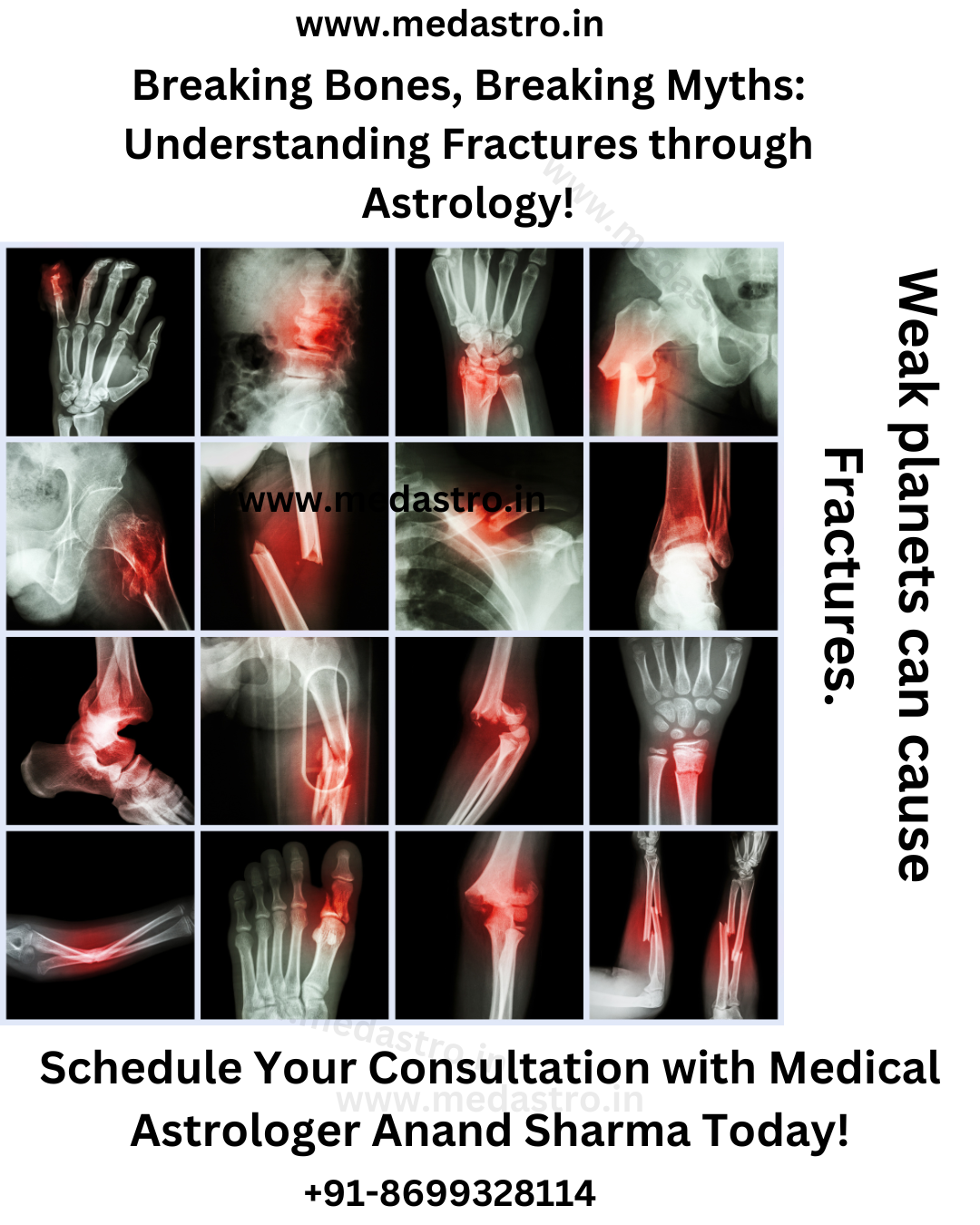 Breaking Bones, Breaking Myths: Understanding Fractures through ...
